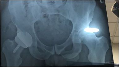 What will Andy Murray's hip resurfacing surgery involve?